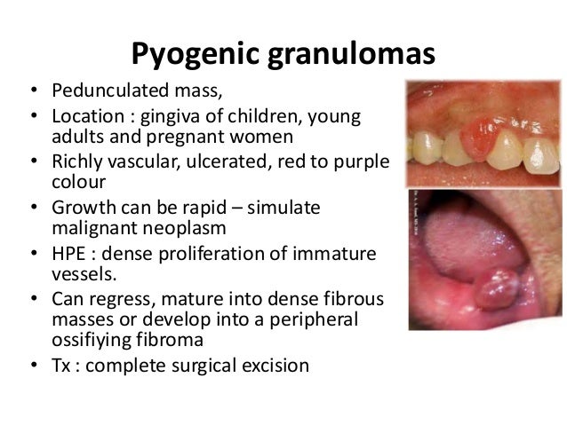 Oral cavity and salivary gland diseases