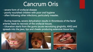 Ahmed Al Abbasi/ Oral Cavity and Tongue diseases, | PPTX