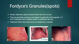 Ahmed Al Abbasi/ Oral Cavity and Tongue diseases, | PPTX