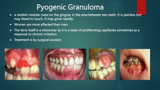 Ahmed Al Abbasi/ Oral Cavity and Tongue diseases, | PPTX