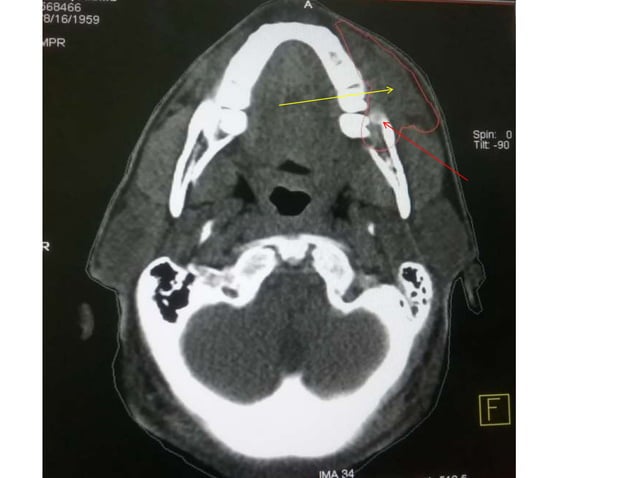 Oral cavity cancer | PPTX | Dental Health | Diseases and Conditions