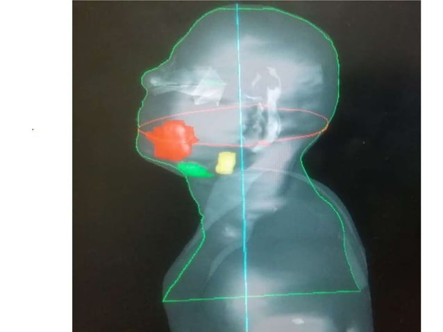 Oral cavity cancer | PPTX | Dental Health | Diseases and Conditions