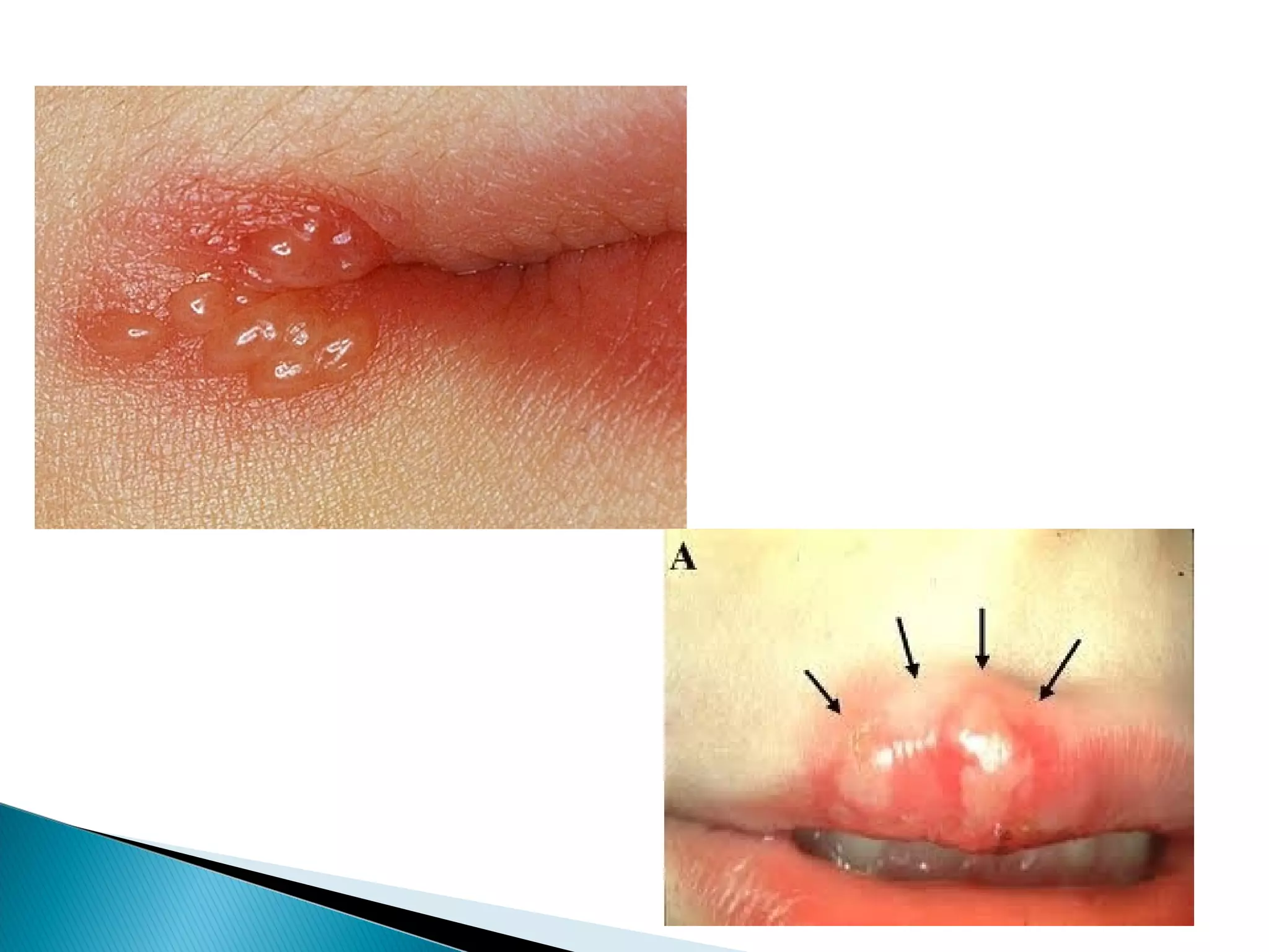 Common Benign Oral cavity disorders by. Dr.vijay kumar | PPT