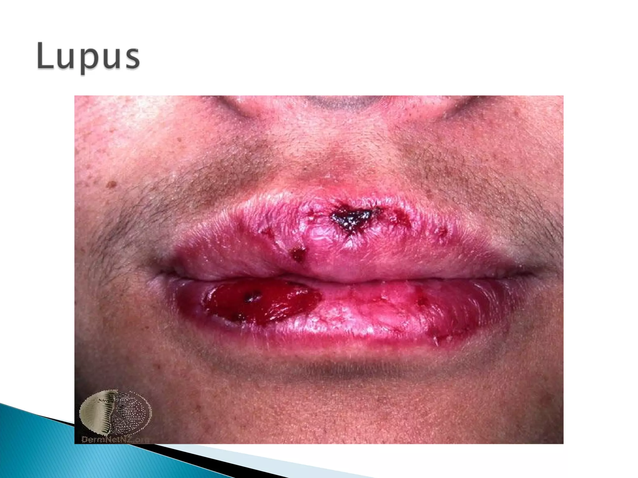 Common Benign Oral cavity disorders by. Dr.vijay kumar | PPT