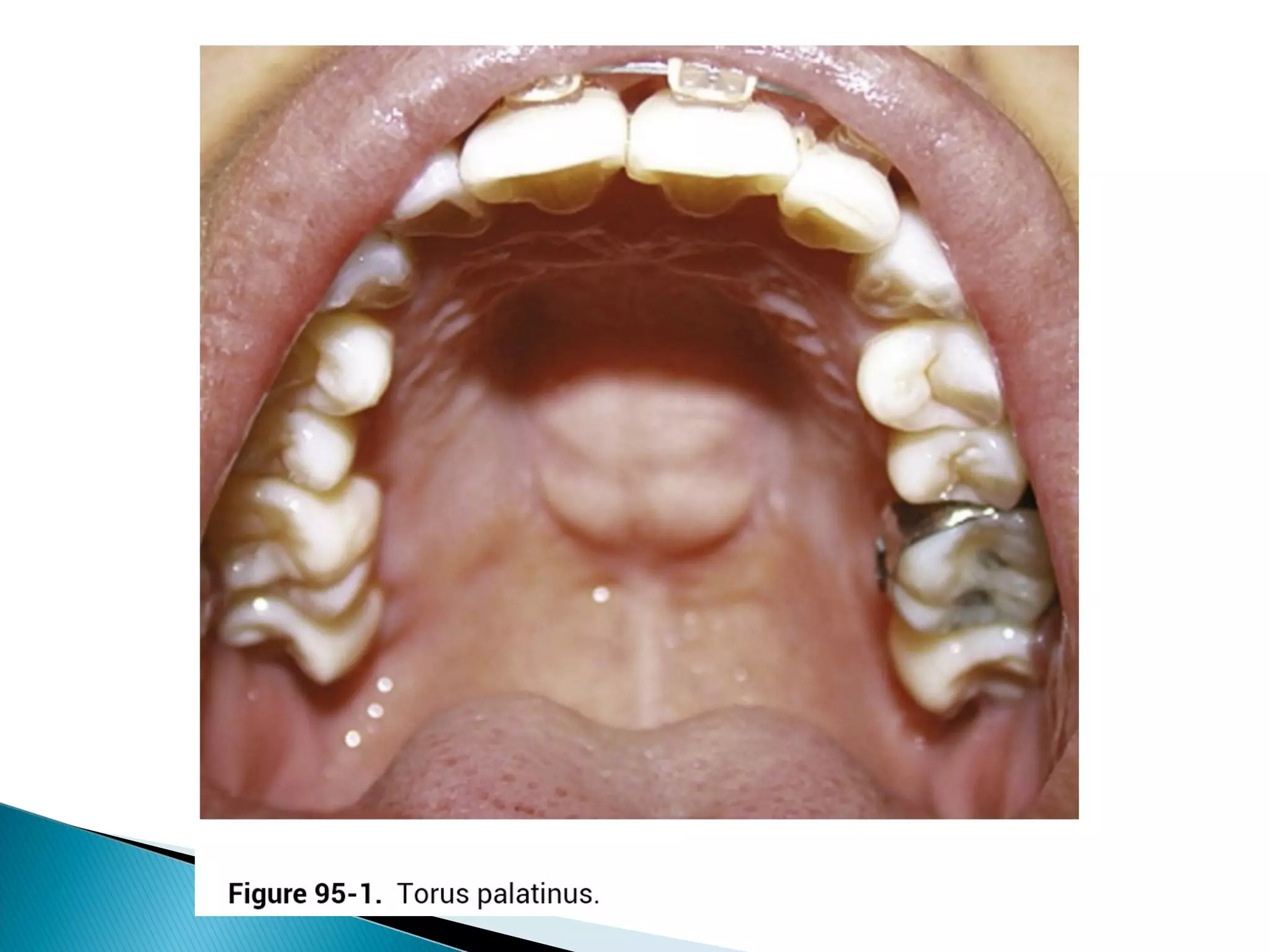 Common Benign Oral cavity disorders by. Dr.vijay kumar | PPT