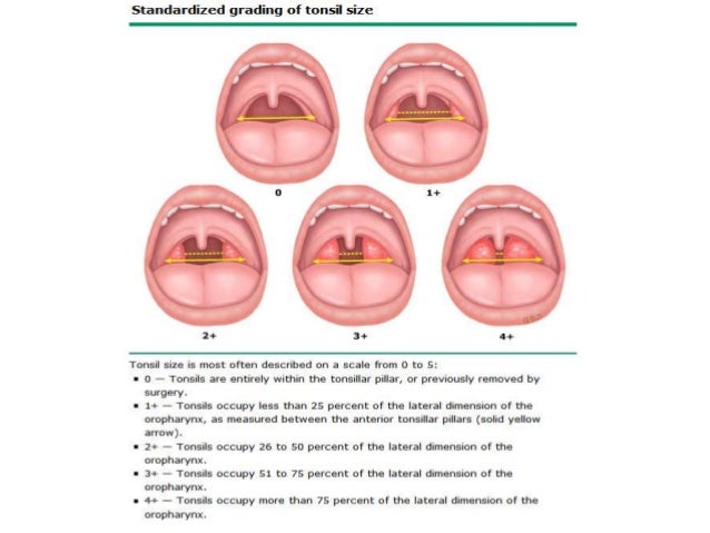 Tonsil Grading Chart