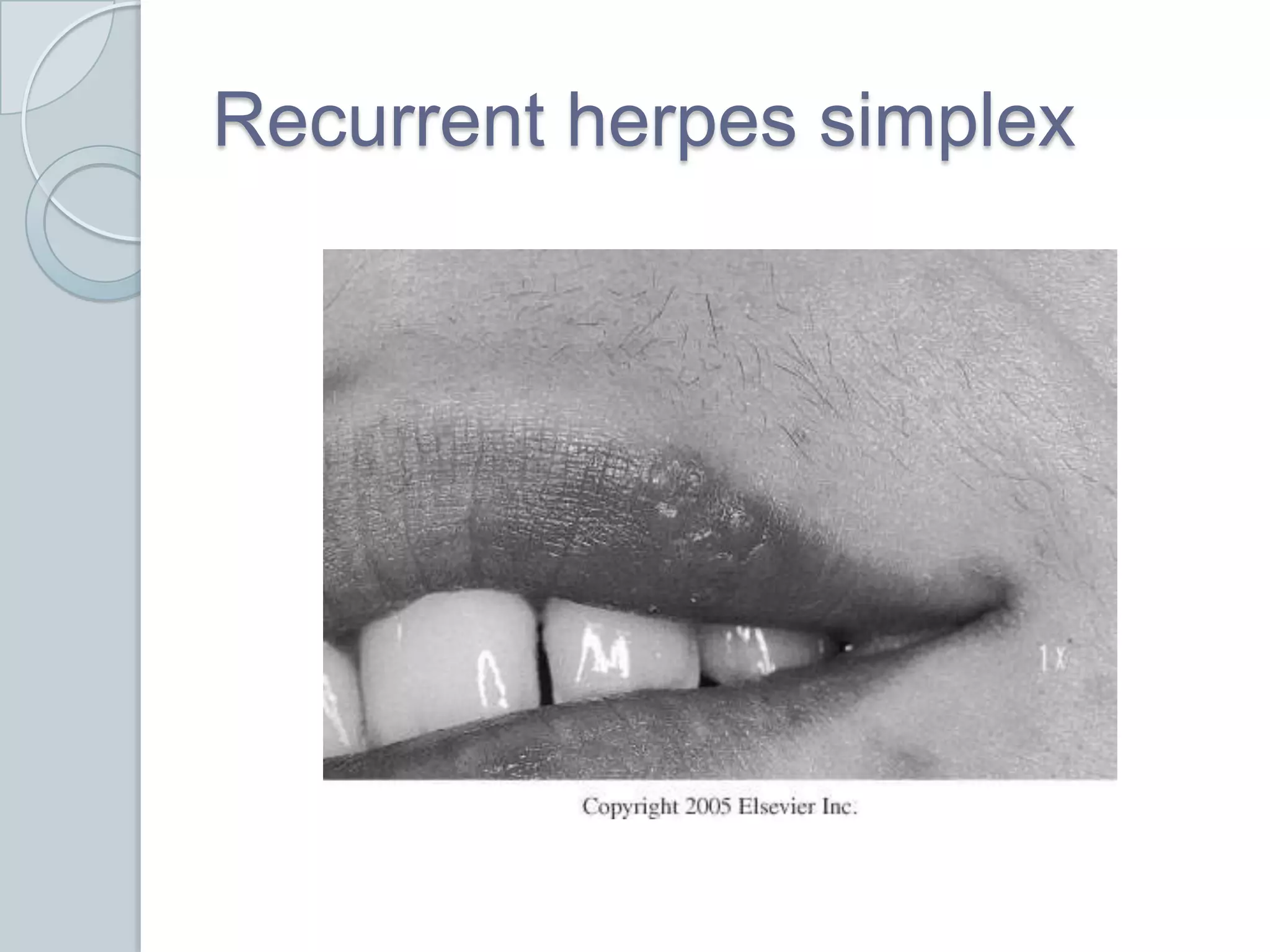 Oral cavity lesions | PPTX