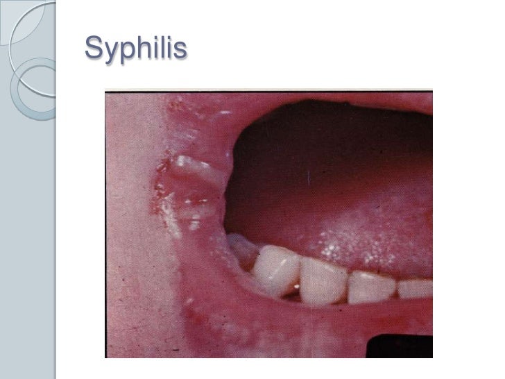 Oral cavity lesions