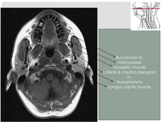 Buccinator Muscle Mri