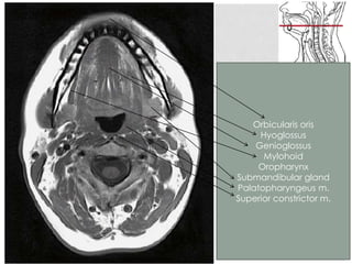 Genioglossus Mri