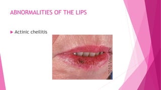 DISORDERS OF THE ORAL CAVITY | PPTX