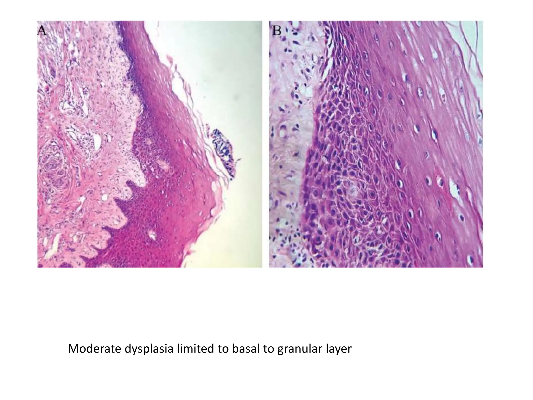 ORAL EPITHELIAL DYSPLASIA: recognition, grading, and clinical ...