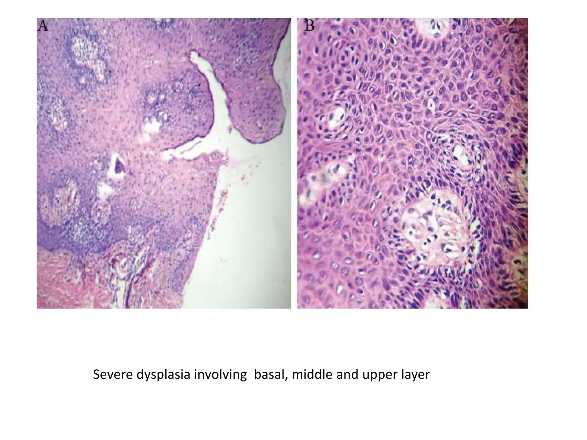 ORAL EPITHELIAL DYSPLASIA: recognition, grading, and clinical ...