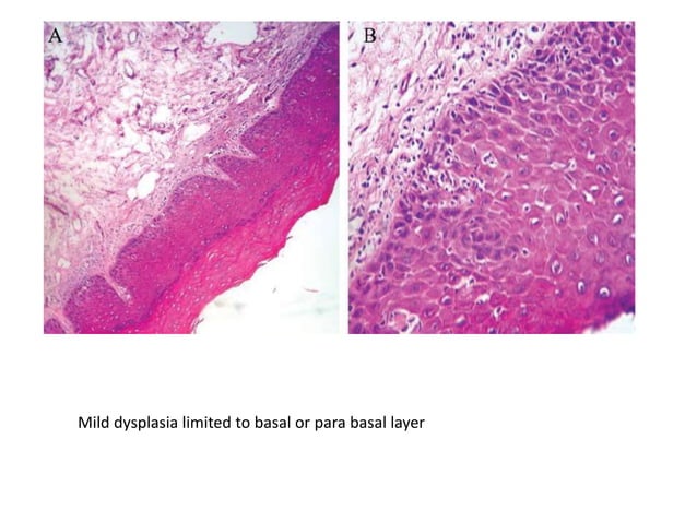 ORAL EPITHELIAL DYSPLASIA: recognition, grading, and clinical ...