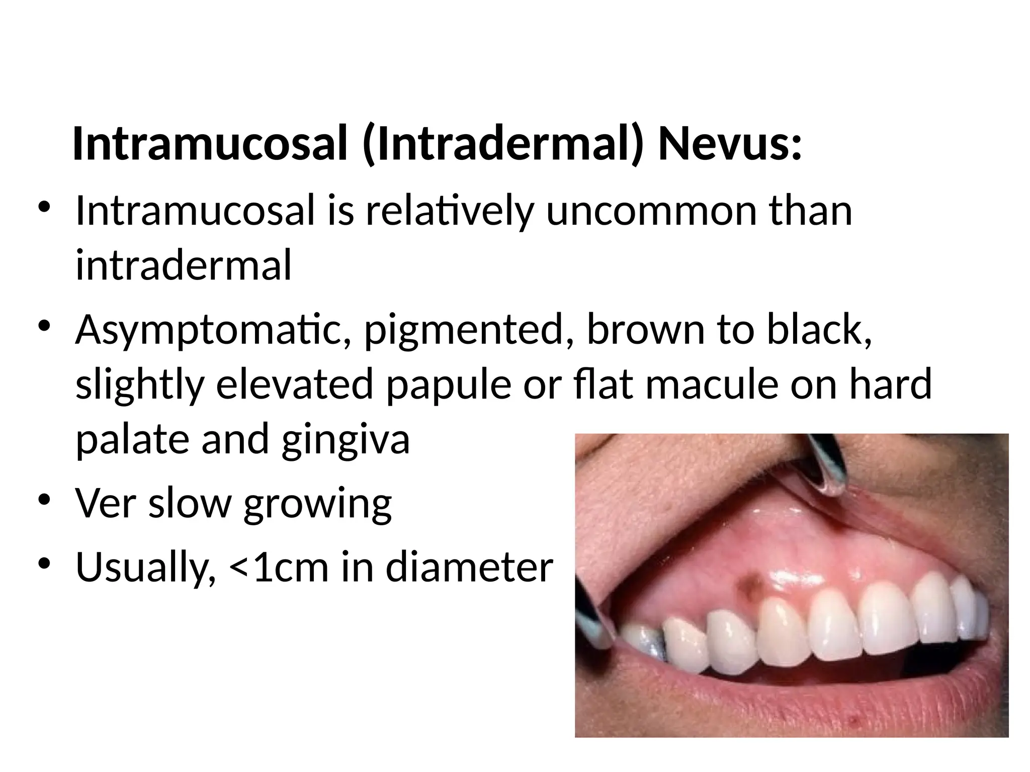 Oral epithelial tumors, melanocytic naevi & malignant melanoma.pptx