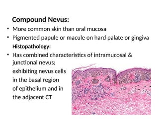 Oral epithelial tumors, melanocytic naevi & malignant melanoma.pptx