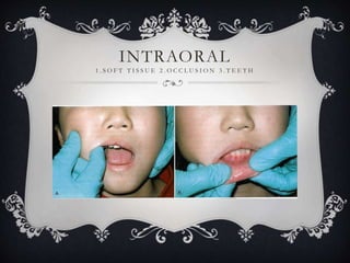Oral examination and other structures in pediatric dentistry | PPTX
