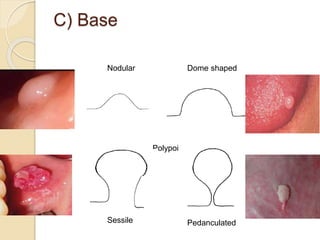 Oral exophytic lesions | PPTX
