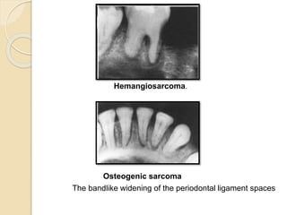 Oral exophytic lesions | PPTX
