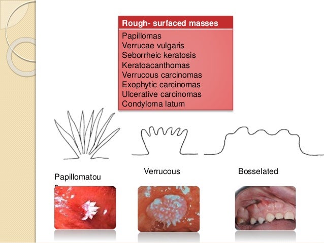 Oral exophytic lesions