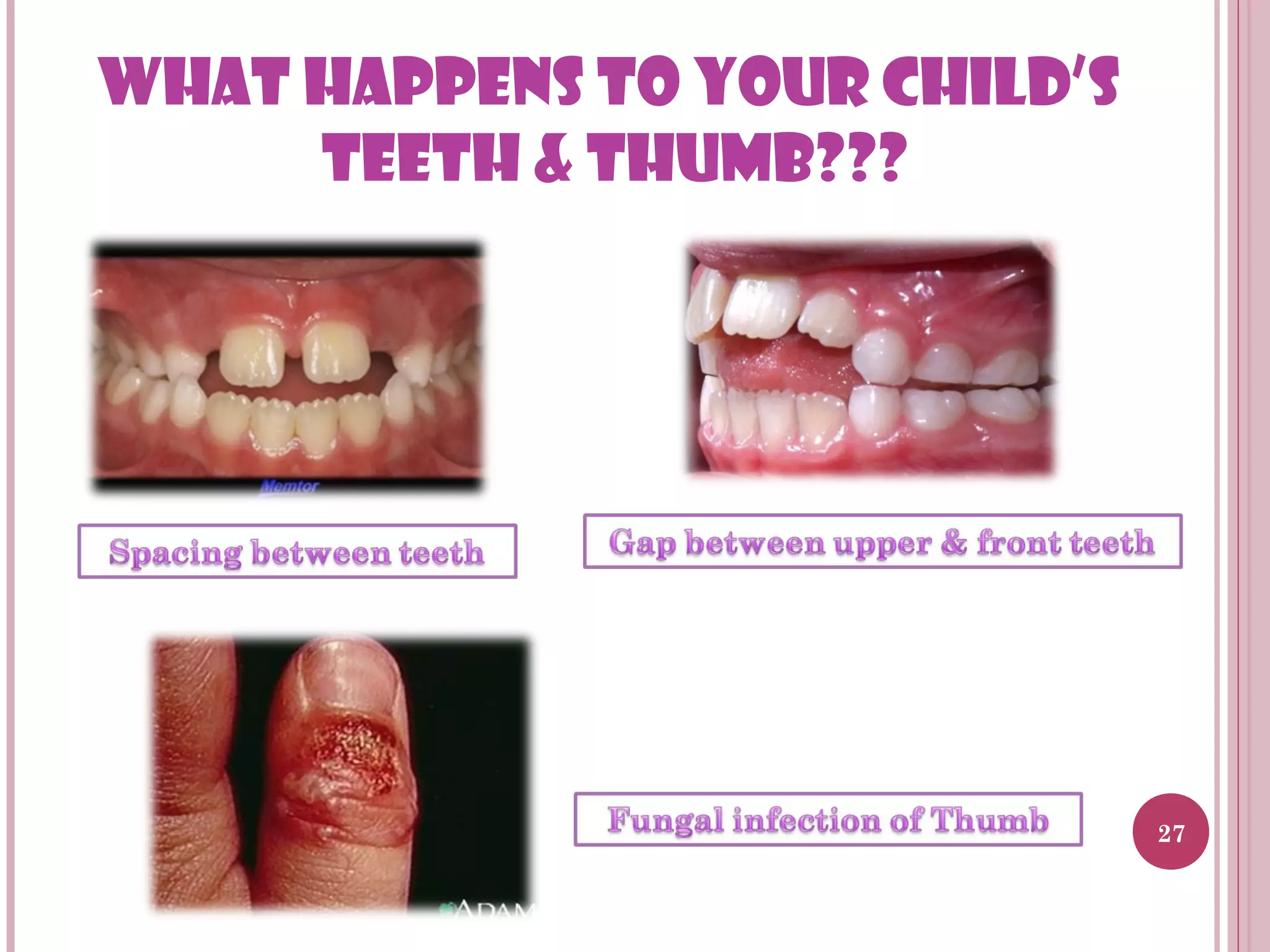 Oral habits - pedodontics | PPT