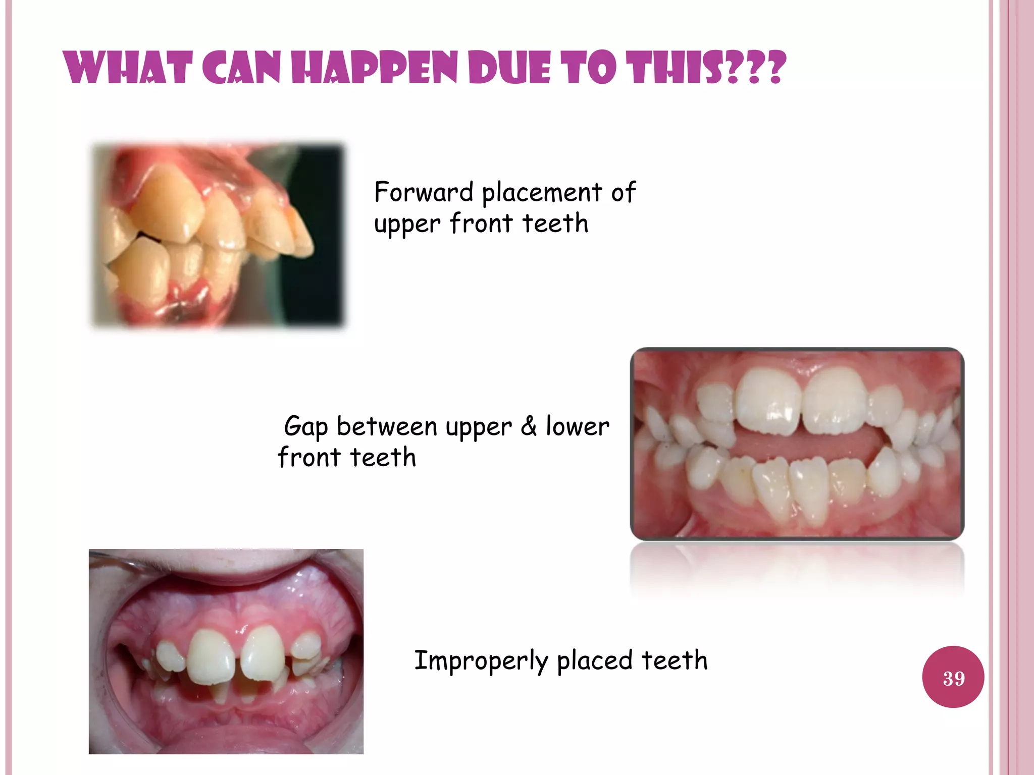 Oral habits - pedodontics | PPT