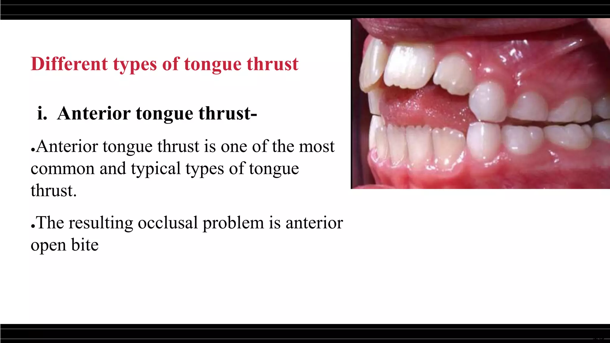Oral habits (part 2) tongue thrusting | PPTX