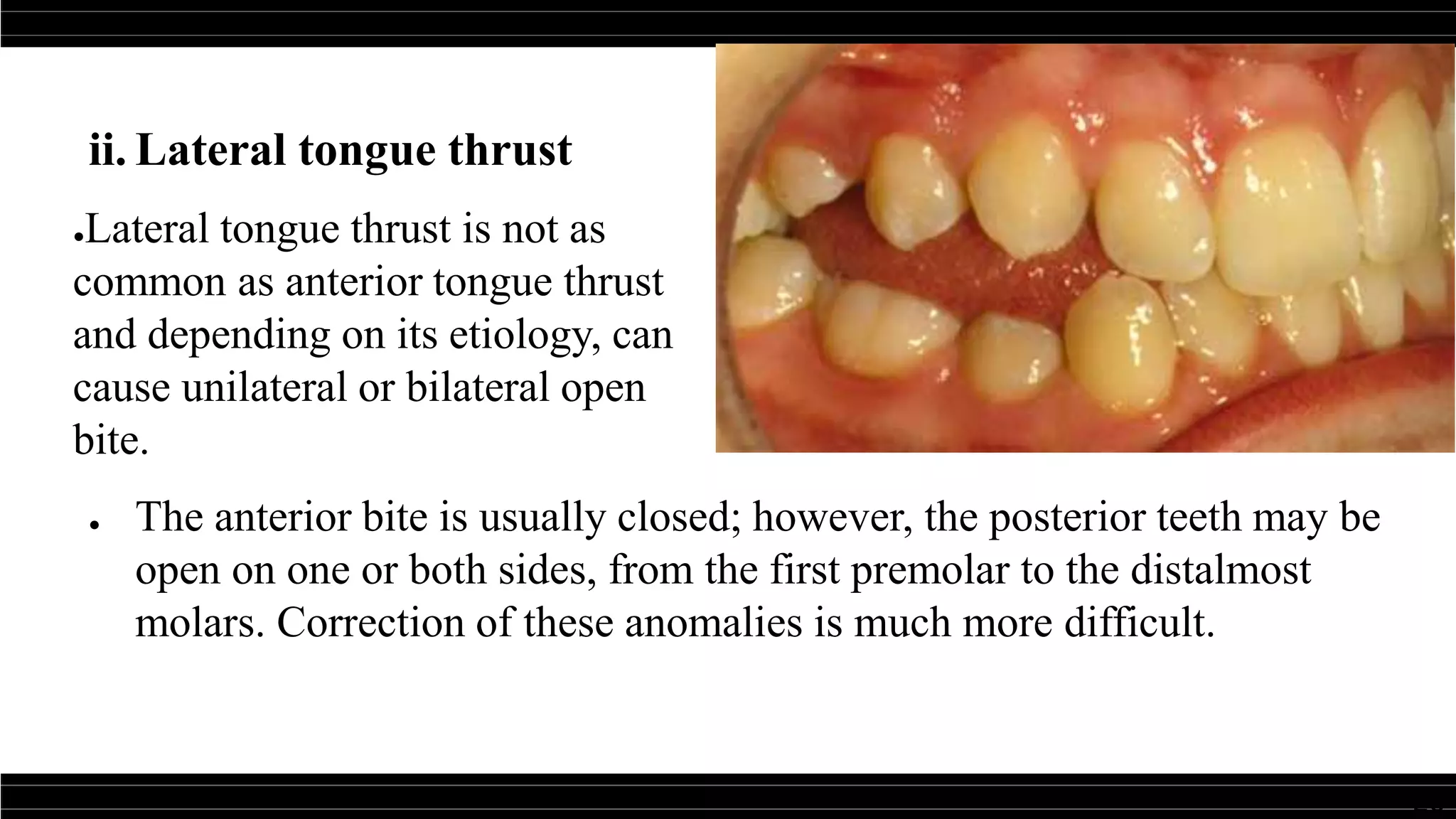 Oral habits (part 2) tongue thrusting | PPTX