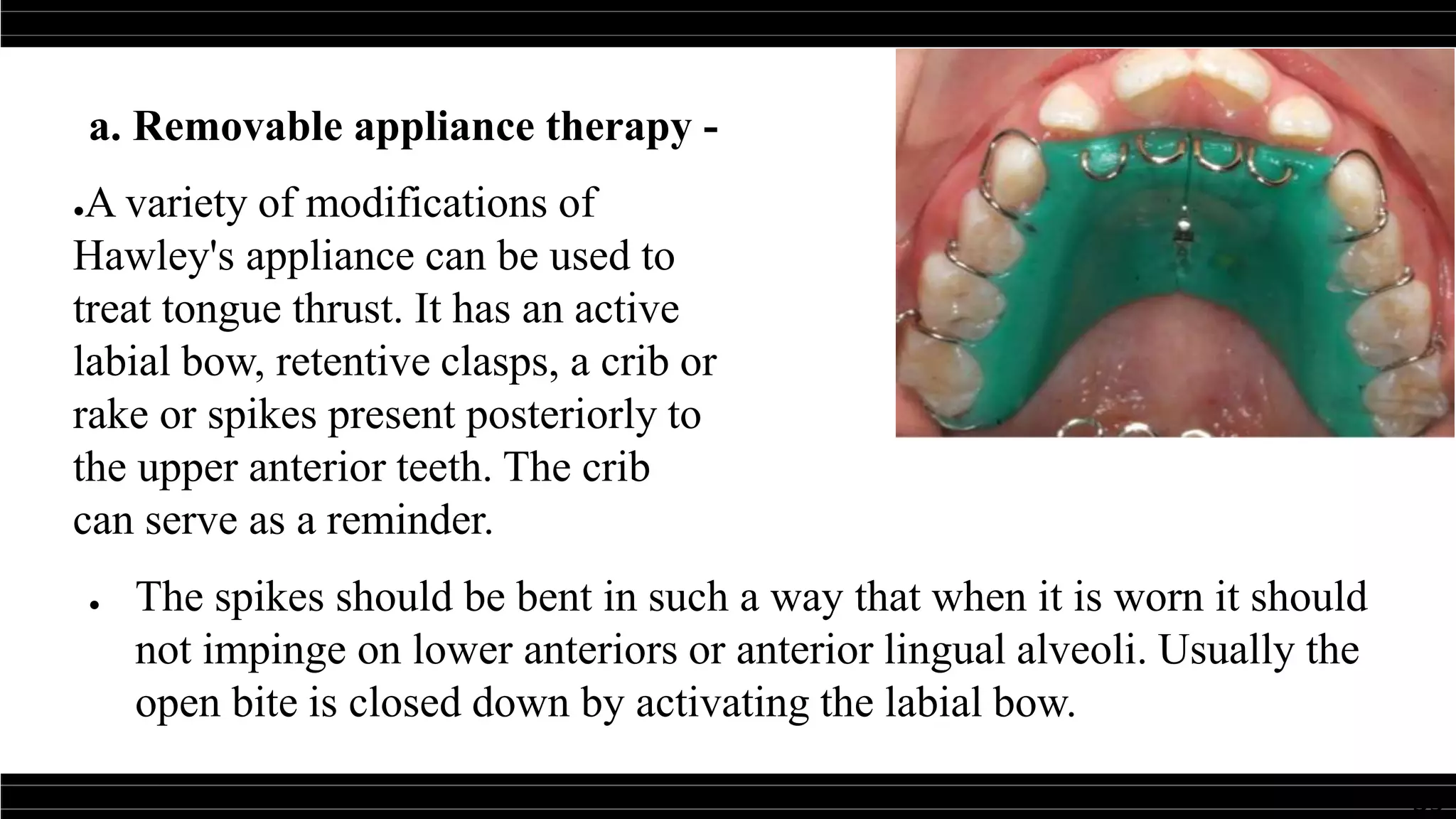 Oral habits (part 2) tongue thrusting | PPTX