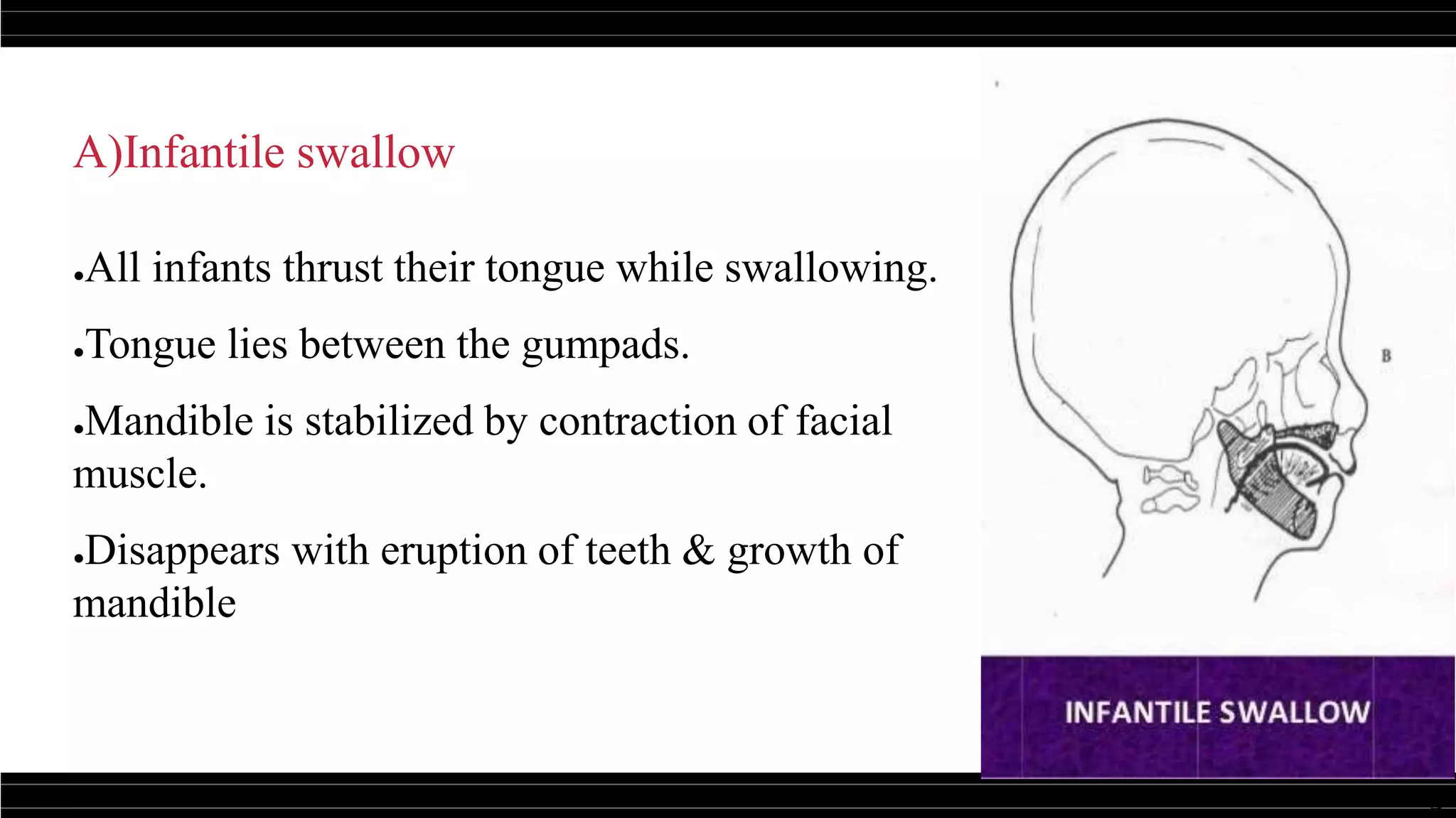 Oral habits (part 2) tongue thrusting | PPTX