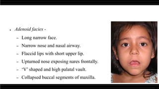 Oral habits part 3 mouth breathing | PPTX