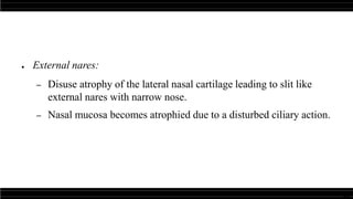 Oral habits part 3 mouth breathing | PPTX