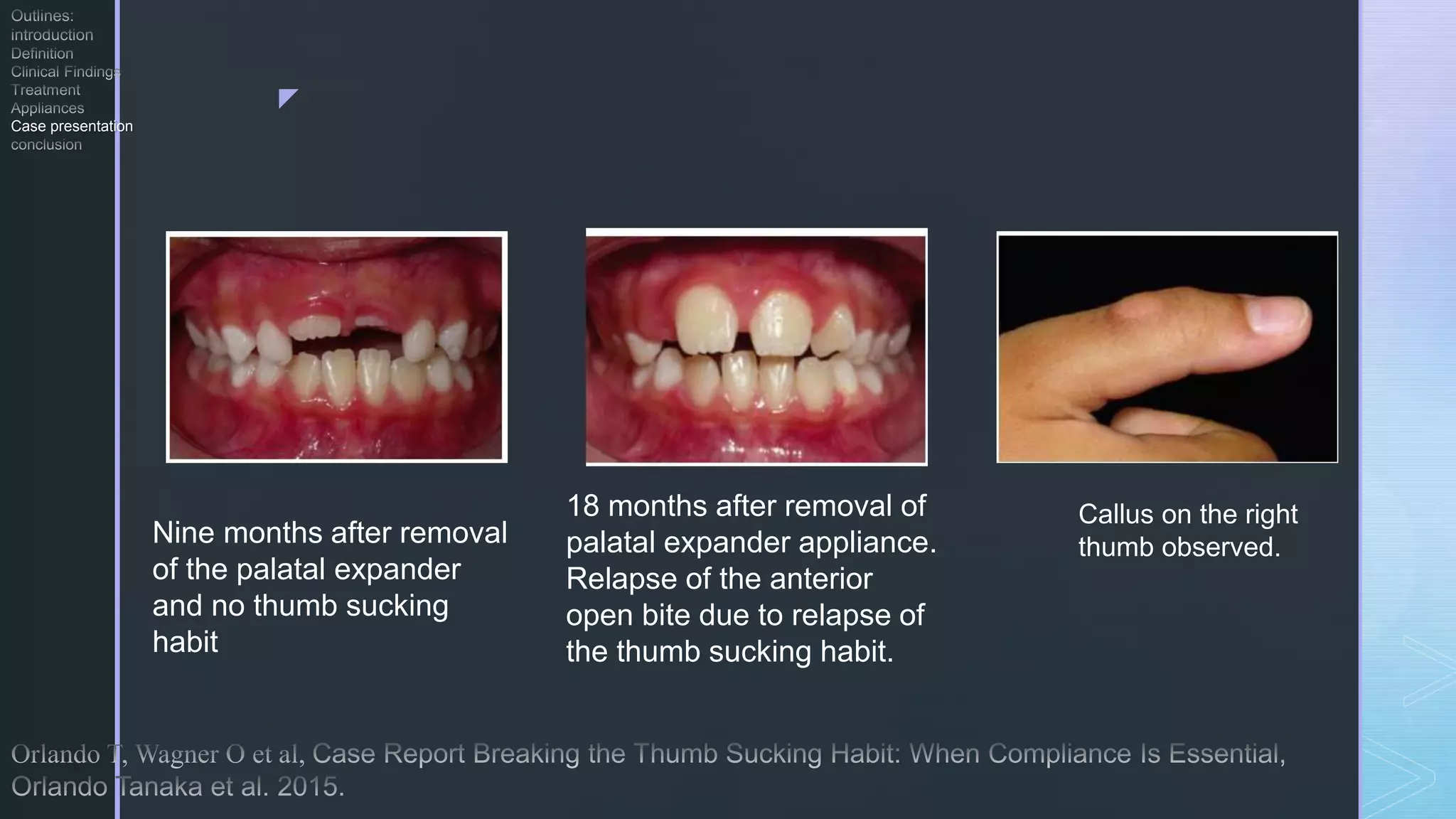 Oral habits (thumb sucking) | PPTX