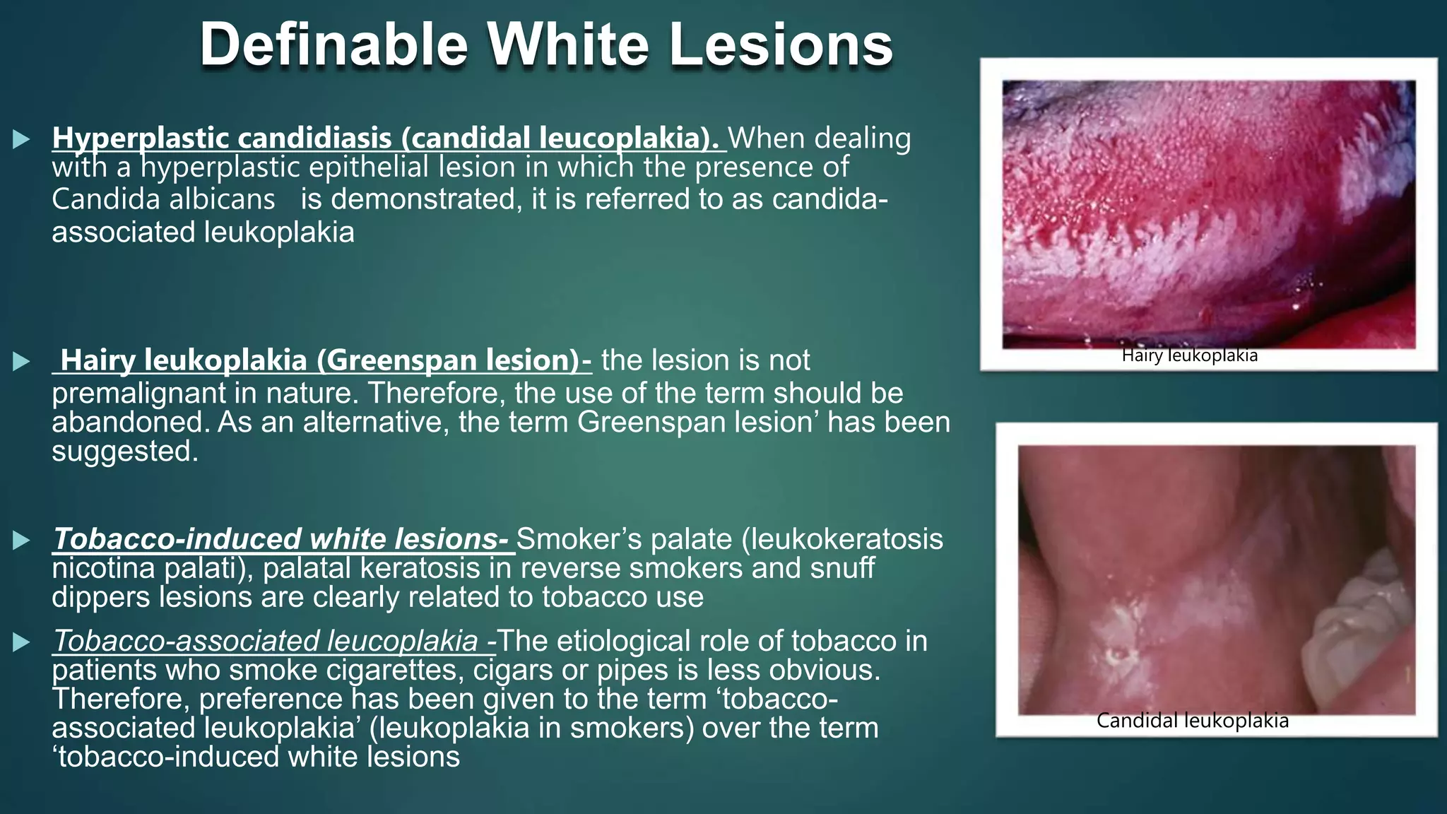 Oral hairy leukoplakia 2 | PPTX