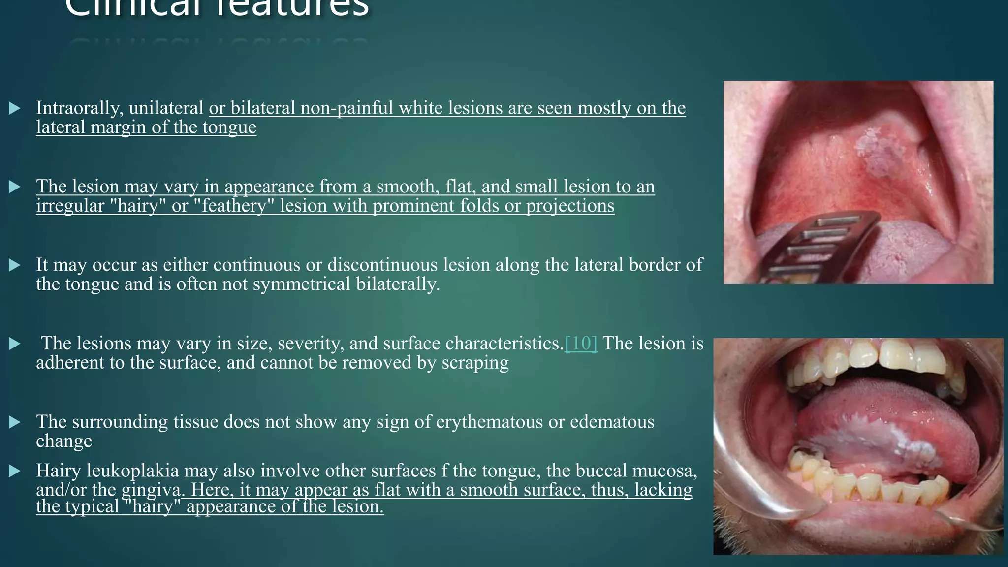 Oral hairy leukoplakia 2 | PPTX