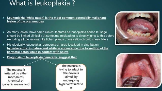 Oral hairy leukoplakia 2 | PPTX | Skin and Dermatology | Diseases and ...