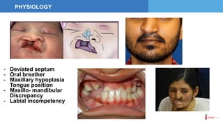 Oral Health for Children with Orofacial Clefts FDI GUIDELINES.pptx