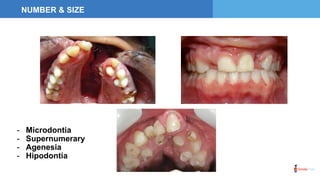 Oral Health for Children with Orofacial Clefts FDI GUIDELINES.pptx