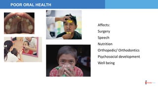 Oral Health for Children with Orofacial Clefts FDI GUIDELINES.pptx