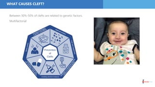 Oral Health for Children with Orofacial Clefts FDI GUIDELINES.pptx