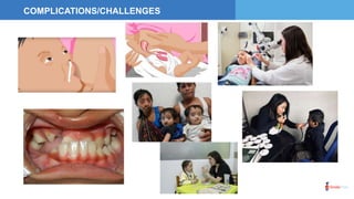 Oral Health for Children with Orofacial Clefts FDI GUIDELINES.pptx