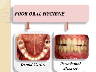 Oral hygiene | PPTX