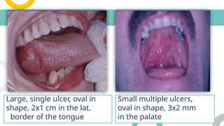 Oral lesions Description and Types .pptx