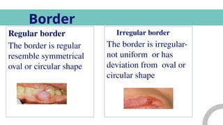 Oral lesions Description and Types .pptx