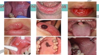 Oral lesions Description and Types .pptx