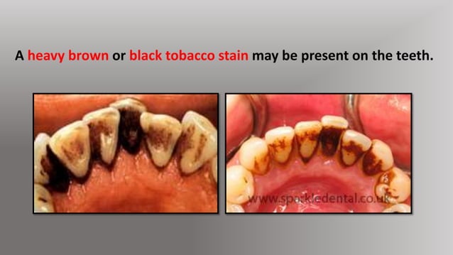 Oral Lesions Associated With The Use Of Tobacco Ppt