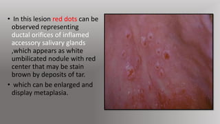 Tobacco Keratosis