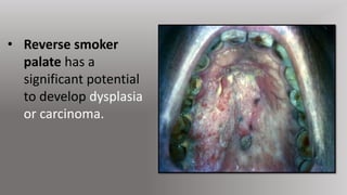 Smokers Palate Histology