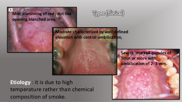 Oral lesions associated with the use of tobacco