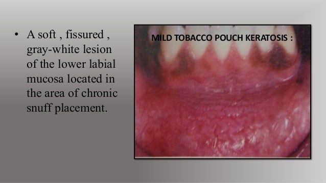 Oral Lesions Associated With The Use Of Tobacco